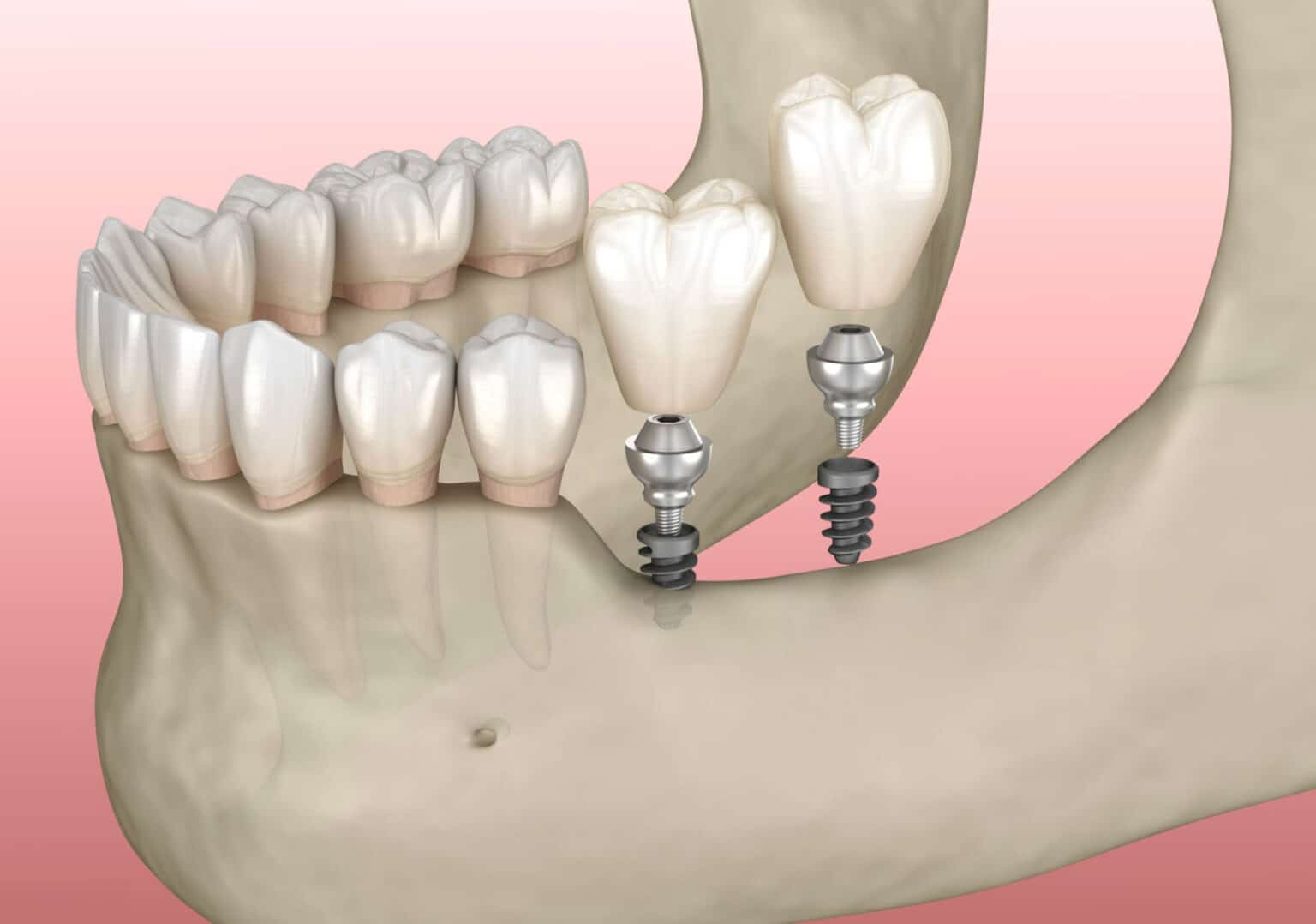 Mini Dental Implants in Hamilton | Efficient Tooth Replacement