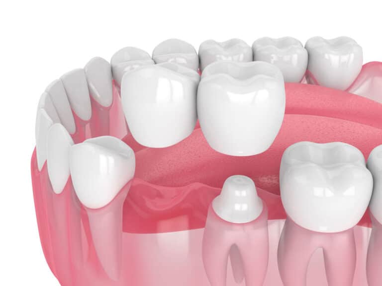 Dental Bridges - Prime Time Dental