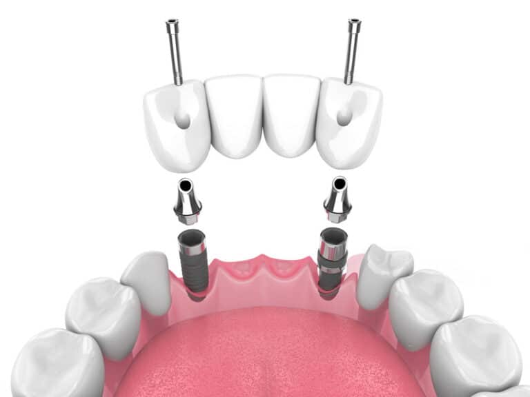 Affordable Dental Bridges In Hamilton | Durable Tooth Replacement